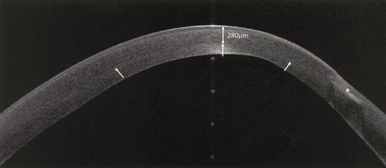 AS-OCT dans le suivi d’ectasie cornéenne et Cross-linking - Medical Deveyes