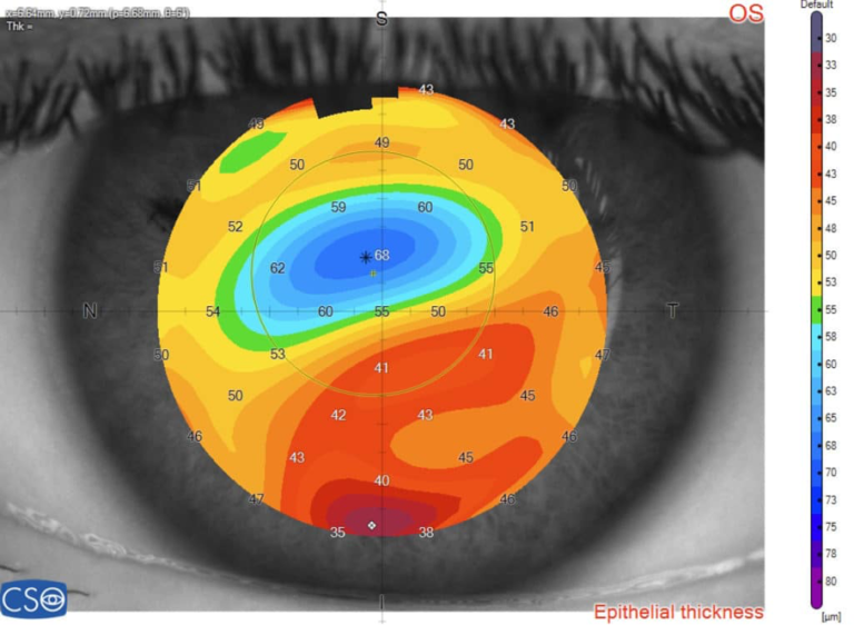 📌 Mais que nous dit le mapping épithélial ⁉️ 🤔 - Medical Deveyes